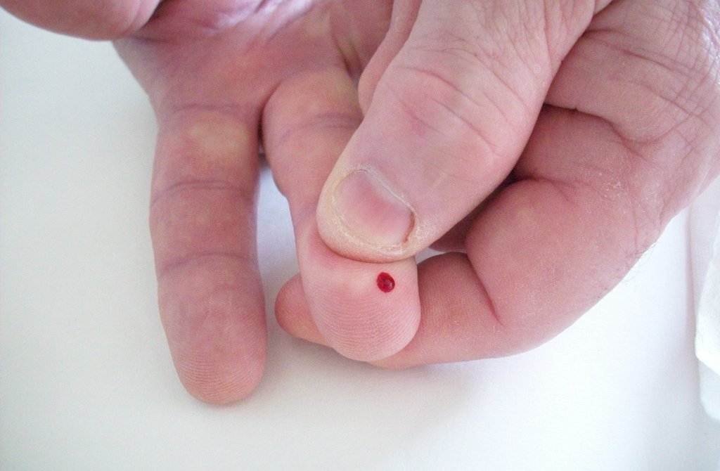 Blood Test For Cancer Is Enormously Exciting Breakthrough Say Scientists