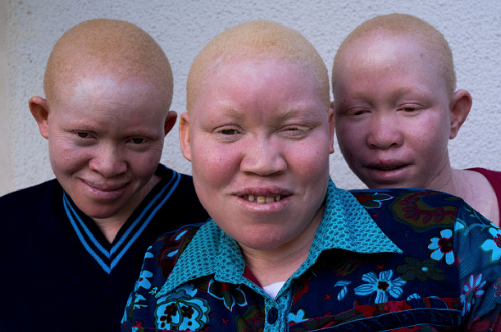 Albino Children in Tanzania — Hunted for Their Body Parts — Get Help in US